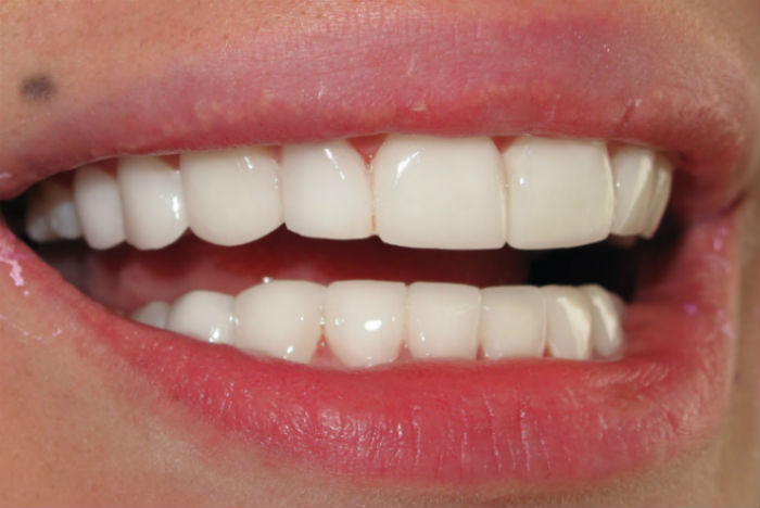 Накладки на зубы: цены и виды зубных накладок на передние зубы в ...